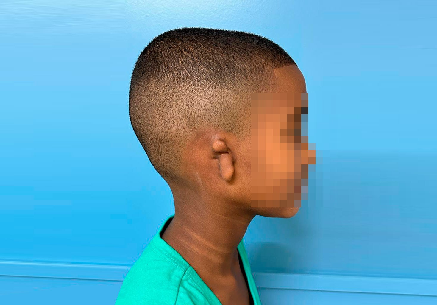 Quem tem microtia pode ouvir? Graus e tratamentos da microtia - Clarice ...